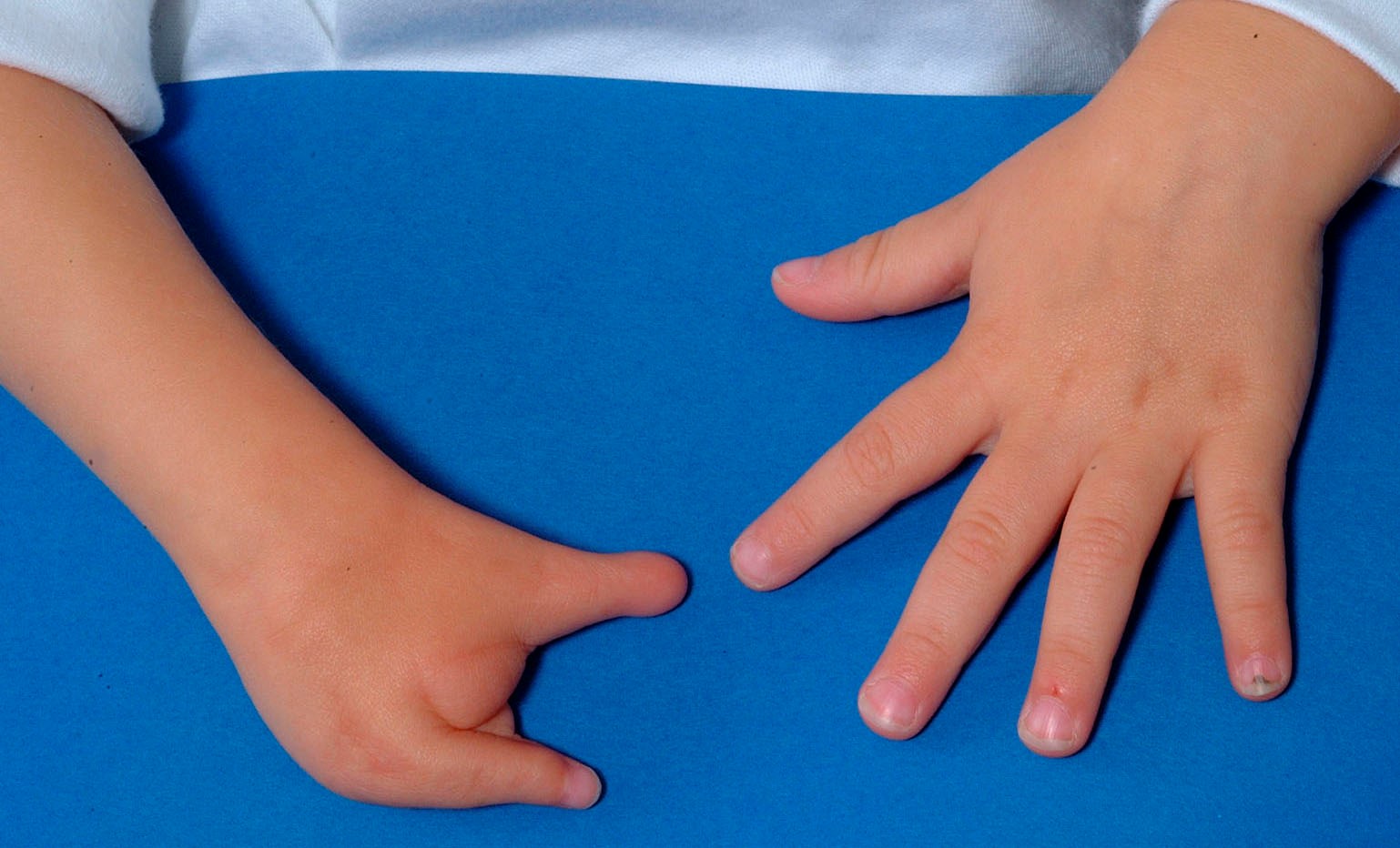 Operation af medfødte håndvariationer - Aarhus Universitetshospital