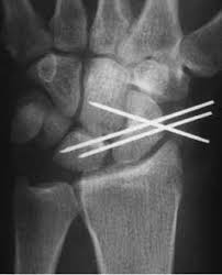 Operation af det scapholunære ledbånd (SL-ledbånd) - Aarhus ...