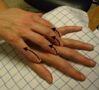 Genoptræning til patienter med vedværende hævelse i hånd og underarm ...