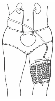 Nyrekateter skift (Røntgen og Skanning) - Aarhus Universitetshospital