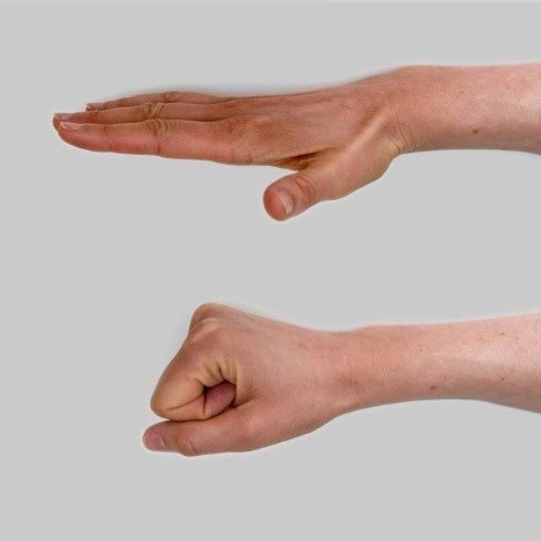 Genoptræning efter løsning af arvæv omkring fingerens strækkesene ...