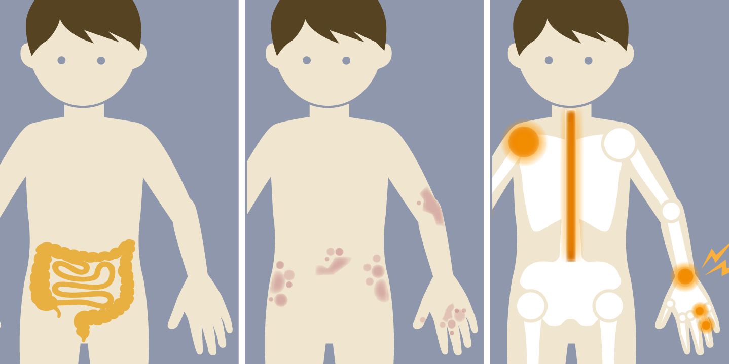 Om autoimmune sygdomme - Aarhus Universitetshospital